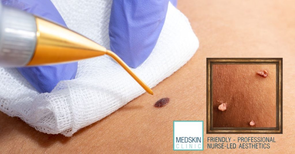 Lunchbreak Facelift Dermal Fillers and Botox in Nottingham ...